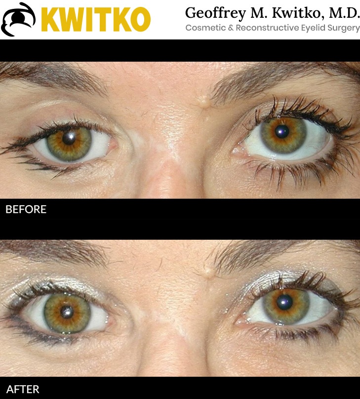 Before and After Photos of Dr. Kwitko Surgeries
