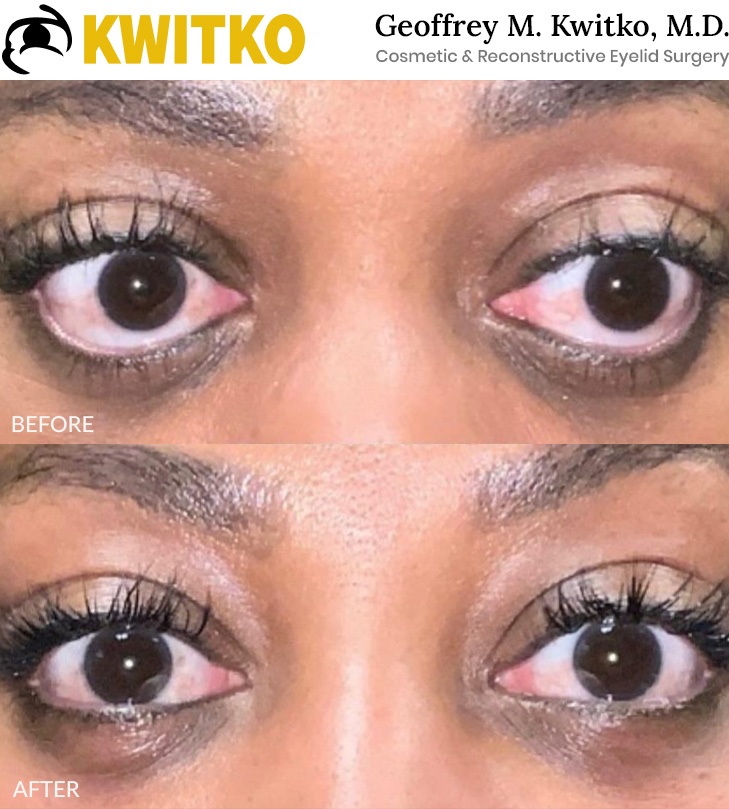 Before and After Photos of Dr. Kwitko Surgeries