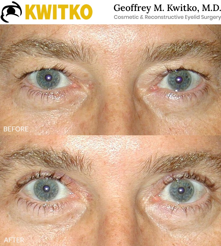 Before and After Photos of Dr. Kwitko Surgeries