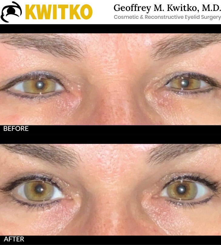 Before and After Photos of Dr. Kwitko Surgeries