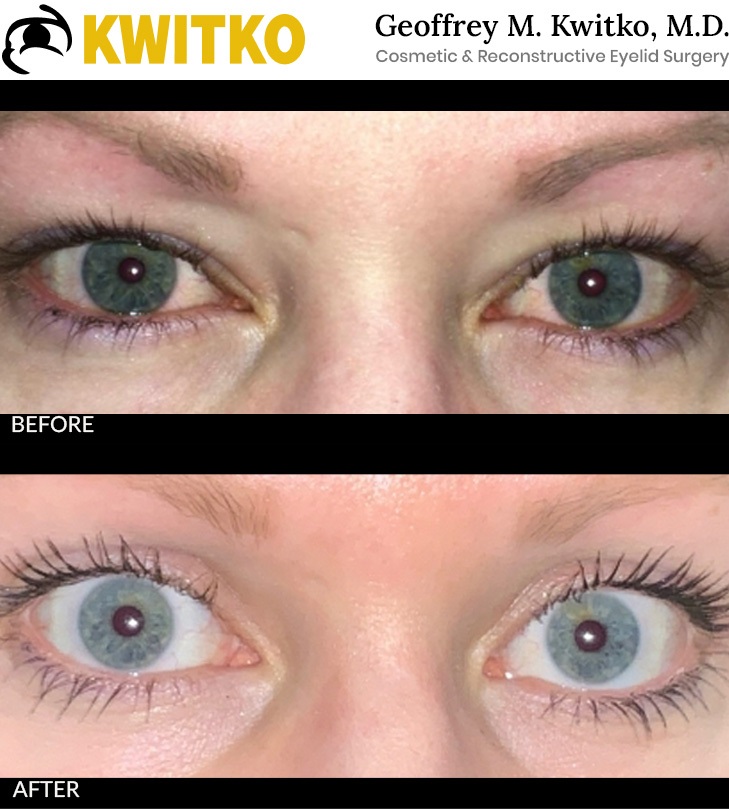 Before and After Photos of Dr. Kwitko Surgeries